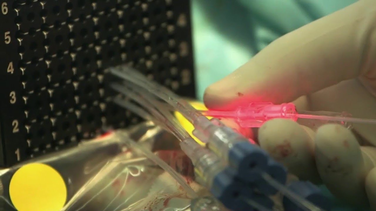 Cancer de la prostate : un nouveau traitement révolutionne la qualité ...